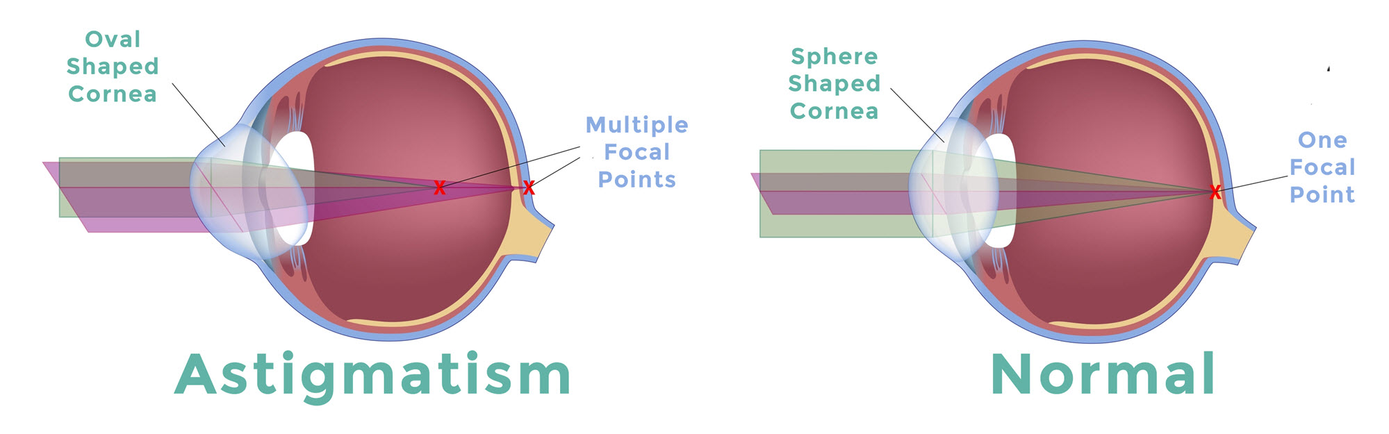 Astigmatism: What You Need To Know – OPTICAL SOLUTIONS Your Trusted Eye ...