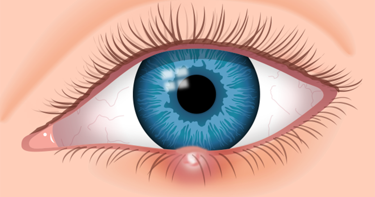Stye and Other Common Eyelid Conditions – OPTICAL SOLUTIONS Your ...